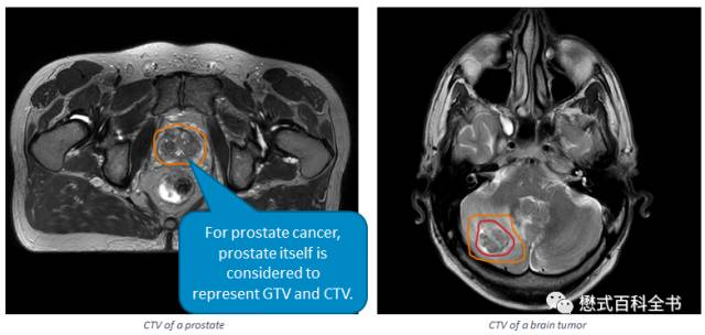 【Medical physics】放疗术语_放疗gtv ptv ctv定义-CSDN博客
