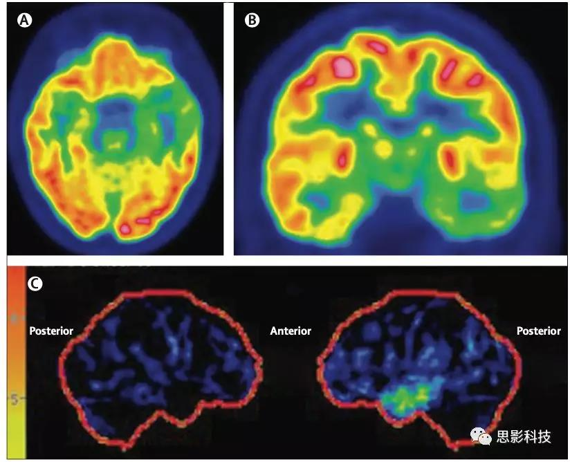 Lancet Neurology：脑成像在评估癫痫手术中的作用_electrical source imaging-CSDN博客