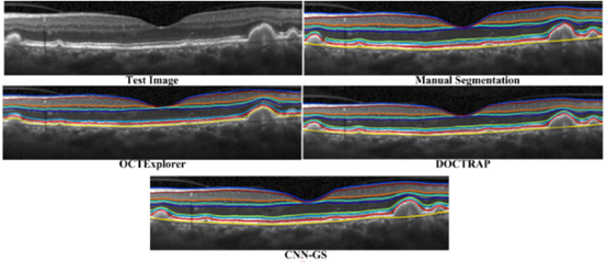OCT图像层次分割相关论文泛读_oct分割-CSDN博客
