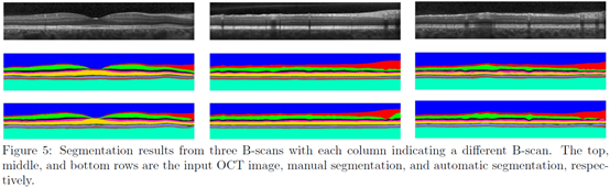 OCT图像层次分割相关论文泛读_oct分割-CSDN博客
