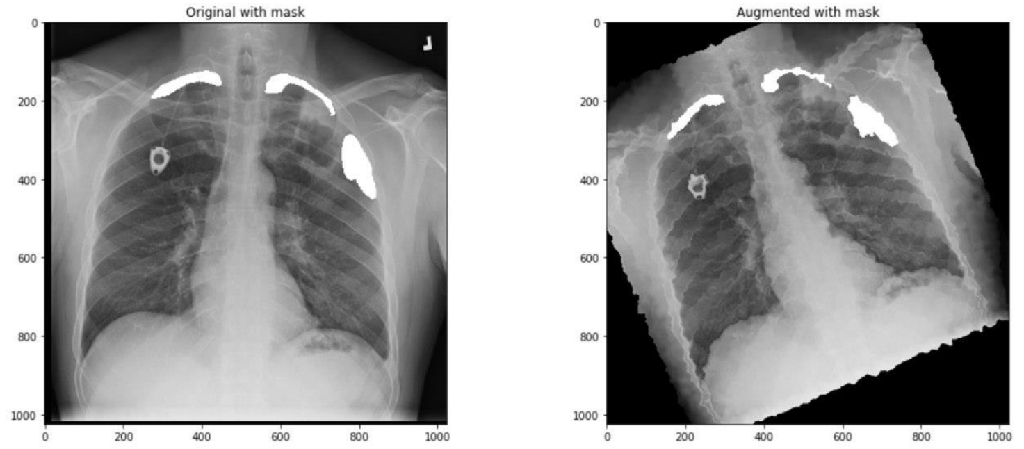 kaggle《SIIM-ACR Pneumothorax Segmentation》第一名方案详解-CSDN博客