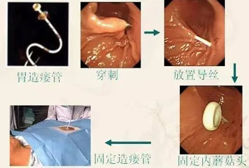 在肚子上开个通到胃大洞，牛瘤胃微生物组是这样研究的 Csdn博客