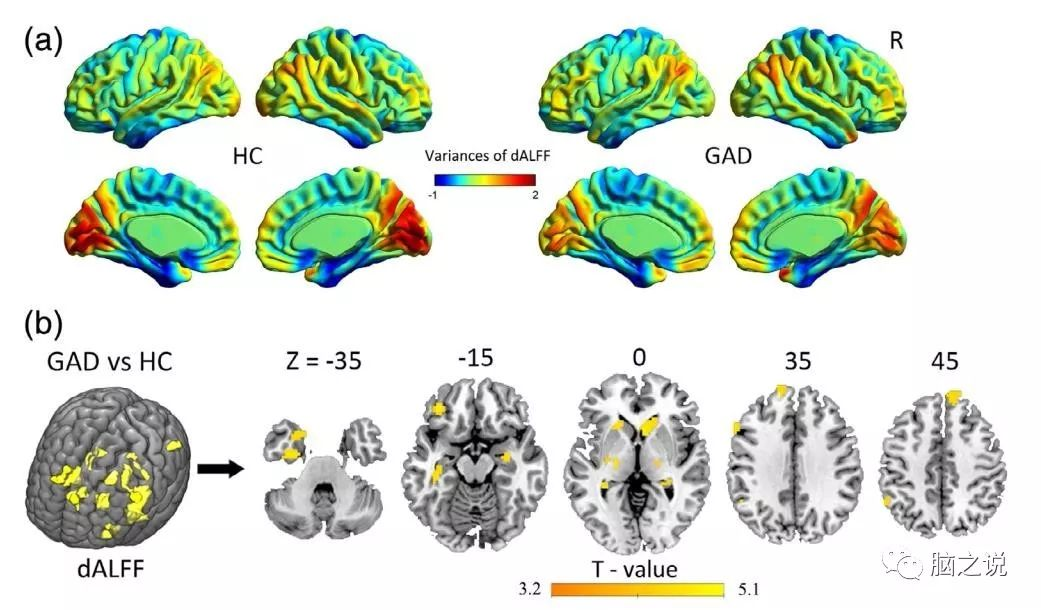 Human Brain Mapping：广泛性焦虑症患者低频振幅ALFF的动态变化 - 我爱神经科学网-脑科学-脑电EEG-事件相关电位ERP ...