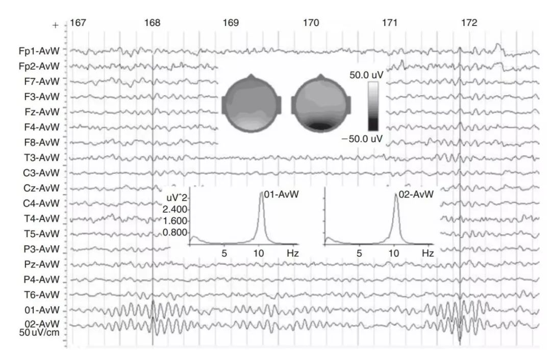 浅谈脑电的alpha频段振荡_alpha oscillation-CSDN博客