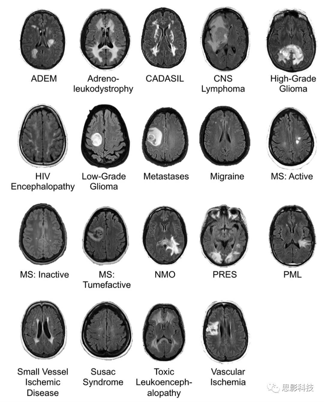Radiology：人工智能系统脑MRI鉴别诊断精度接近神经放射科医生水平_人工智能or比值比-CSDN博客