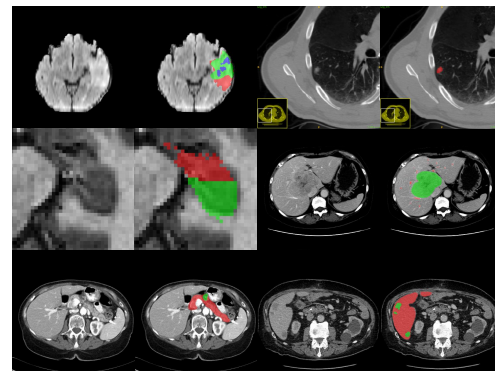 CVPR 2020 论文大盘点-医学影像处理识别篇_医学图像识别论文-CSDN博客