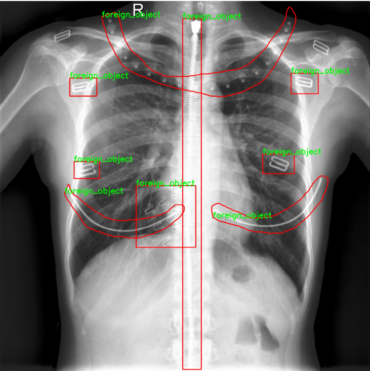 MIDL2020赛事object-CXR(胸部X射线异物检测大赛)-CSDN博客
