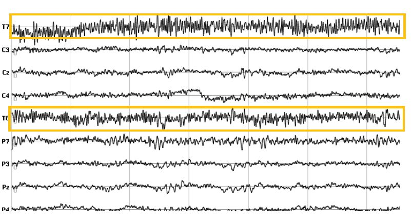 动态脑电图(Ambulatory EEG)及其工作过程、数据处理！_mne 脑电波数据清洗 通过高度和滤波(300hz)-CSDN博客