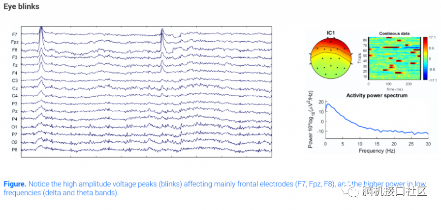EEG中常见的伪迹与干扰 - 程序员大本营