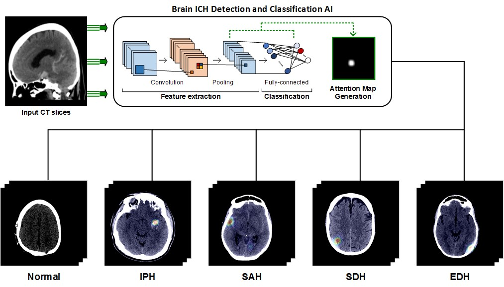 原创 | 基于AI的智能急性颅内出血类型检测-CSDN博客