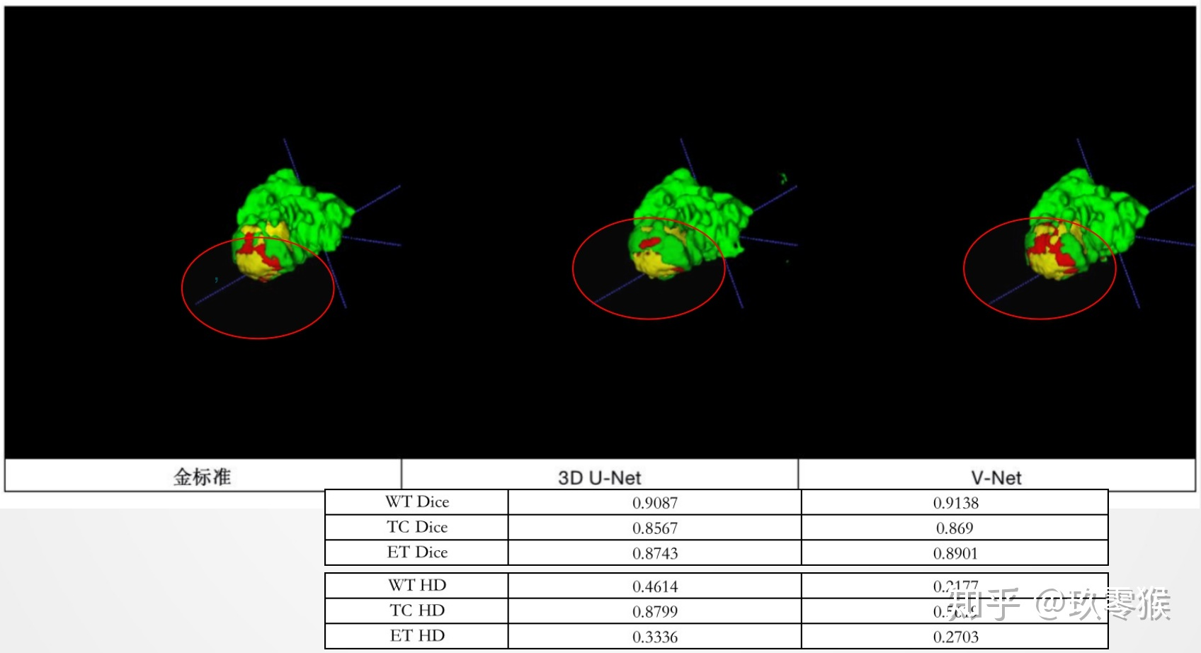 3DV-Net脑胶质瘤分割BraTs + Pytorch实现_3d vnet-CSDN博客