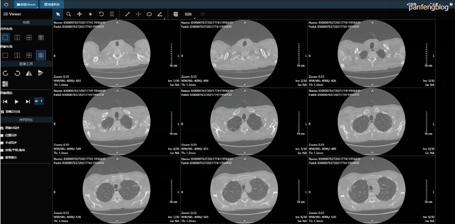 Dicom文件打开（.dcm后缀）_dicomfile和.dcm文件转换-CSDN博客